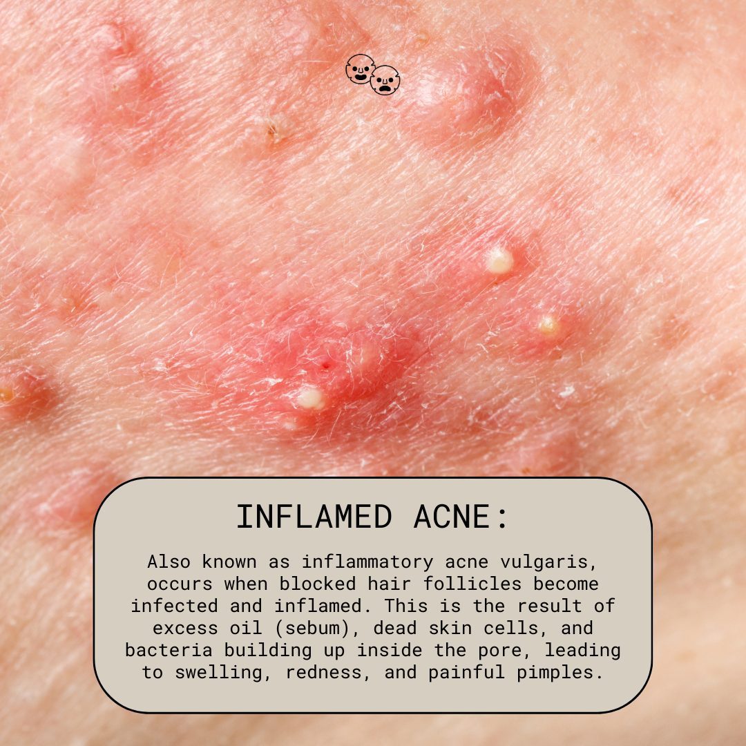 What Is Inflamed Acne? | Sofie Pavitt Face
