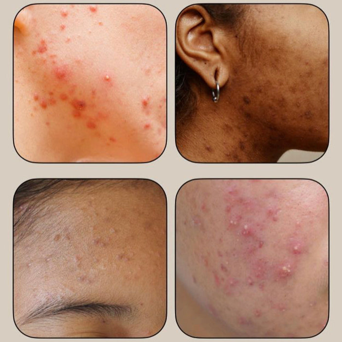 How to Identify Your Acne Type – Sofie Pavitt Face