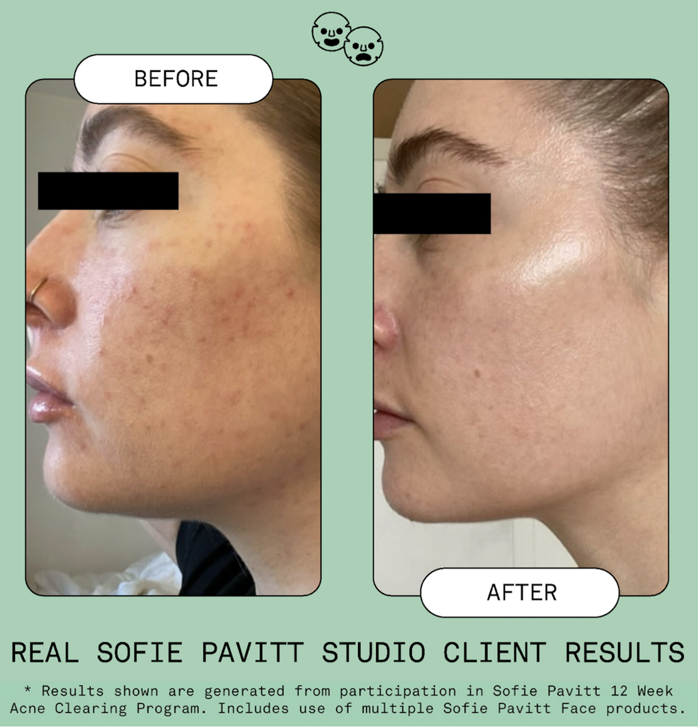 Nice Ice Frozen Toner Pods | Sofie Pavitt Face