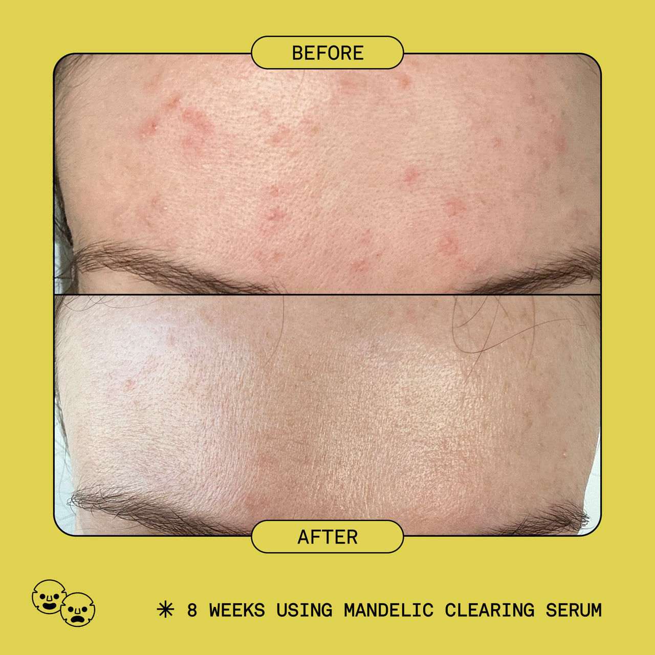 Mandelic Clearing Serum | Exfoliating Serum for Acne Prone Skin – Sofie ...