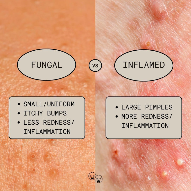 How to Clear Fungal Acne | Sofie Pavitt Face