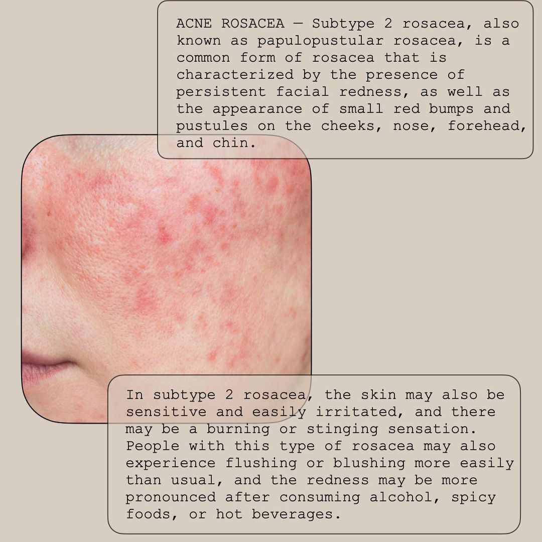 How to Identify Your Acne Type – Sofie Pavitt Face