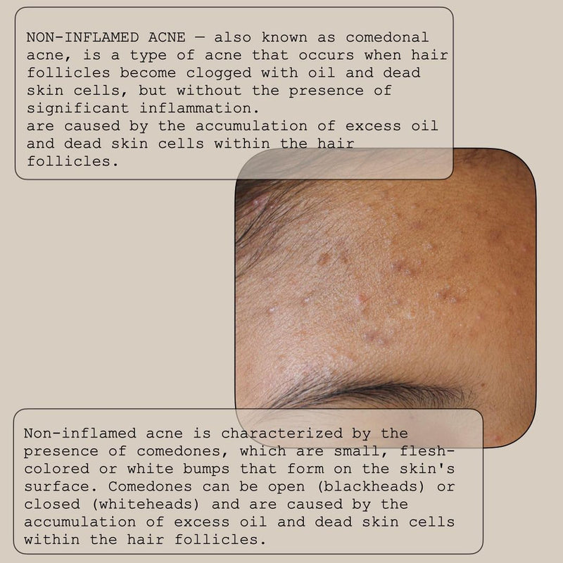 How to Identify Your Acne Type – Sofie Pavitt Face